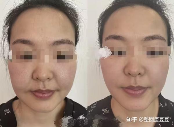 火遍全网的“超声炮”到底是什么？真的值得做吗？适合哪些人群？你想知道的都在这里！