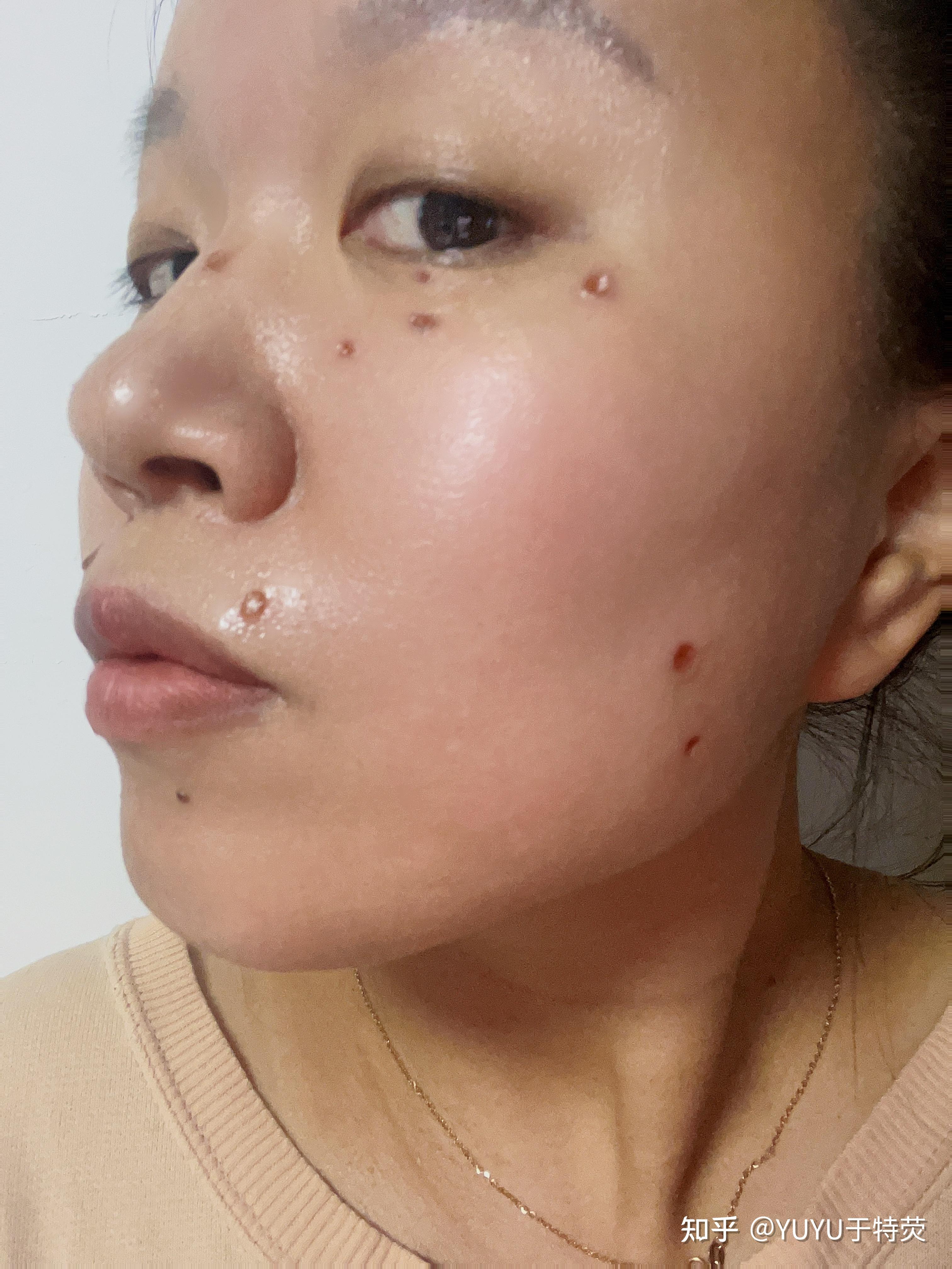 Day5：术后第四天，结大痂，翘边了 - 知乎