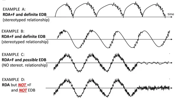 王群教授：2021重症脑电图监测术语更新！ - 知乎