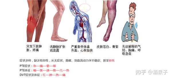 VTE、DVT与PE的关系 - 知乎