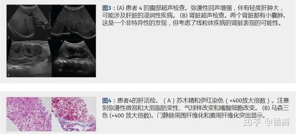 Pearson Syndrome皮尔逊综合征（PS）引起贫血、胰腺外分泌缺陷、视力异常的线粒体疾病 - 知乎