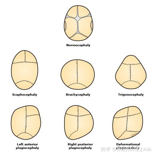 Concezio Di Rocco教授三角头畸形“剥壳术”手术技巧 - 知乎