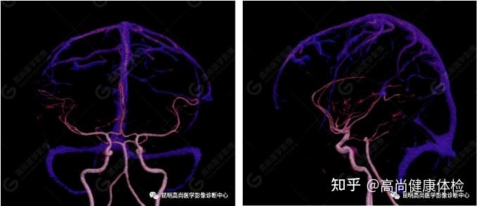 什么是CTA检查？哪些人需要做这个检查？ - 知乎