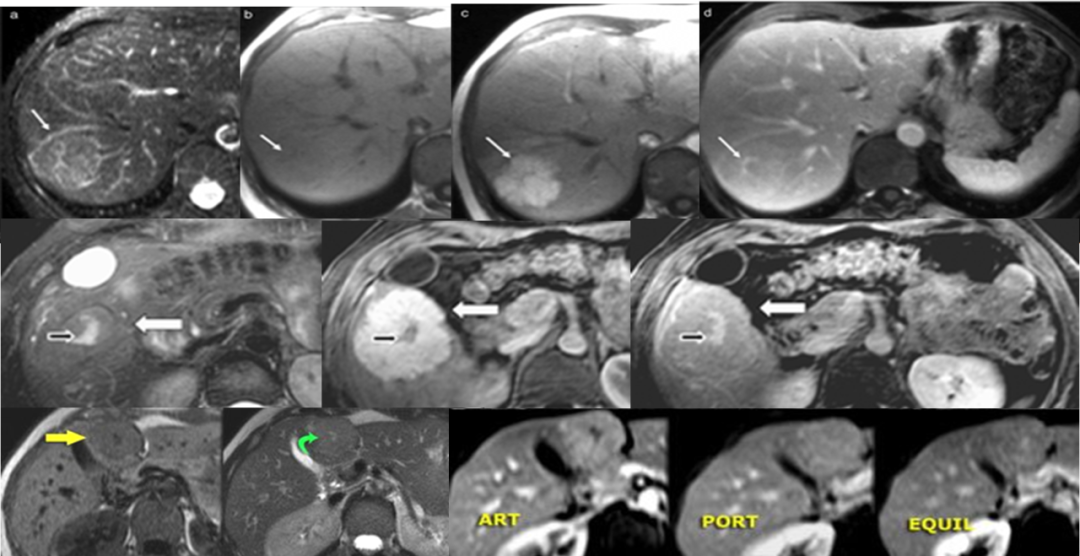 【高尚病例】FNH（肝局灶性结节增生） - 知乎