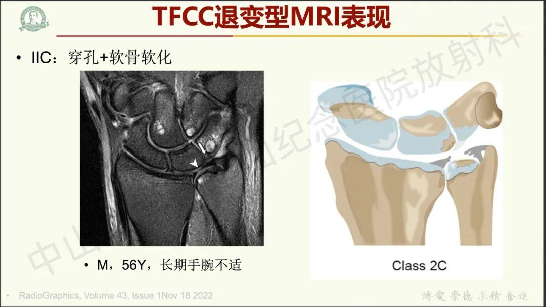 TFCC损伤MRI诊断 - 知乎