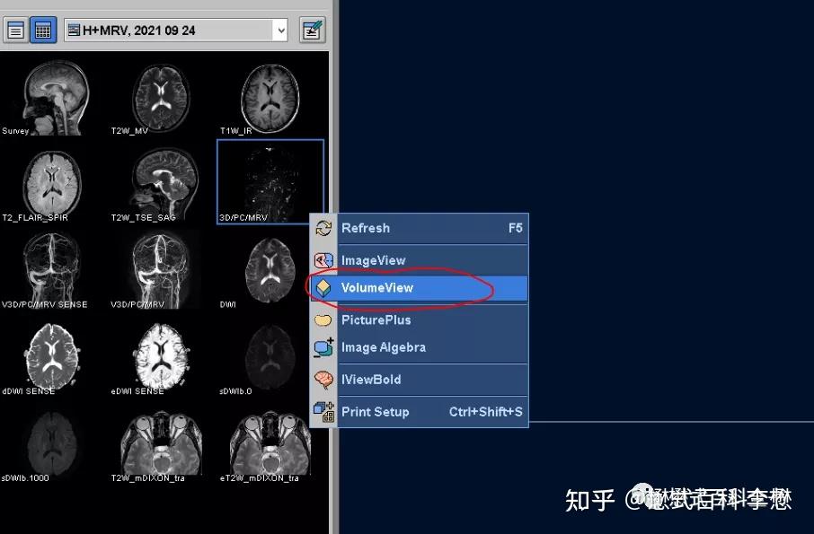 颅脑静脉MRV规范化扫描及临床应用 - 知乎