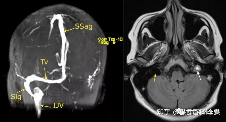 颅脑静脉MRV规范化扫描及临床应用 - 知乎