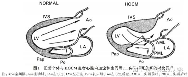 肥厚型梗阻性心肌病中二尖瓣前叶收缩期前向运动的机制与处理策略 - 知乎