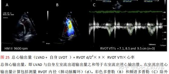 美国超声心动图学会指南及标准超声心动图在左心室辅助装置管理中的应用 - 知乎
