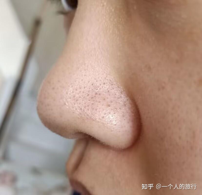 火爆全网的hde荷荷巴油真的可以去黑头吗?为什么有那么多人买hde荷荷巴油去黑头? 知乎