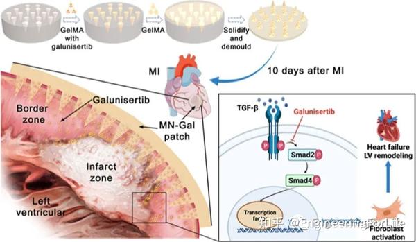 《ACS AMI》：负载 Galunisertib 的GelMA水凝胶微针贴片，用于心肌梗塞后的心脏修复 - 知乎
