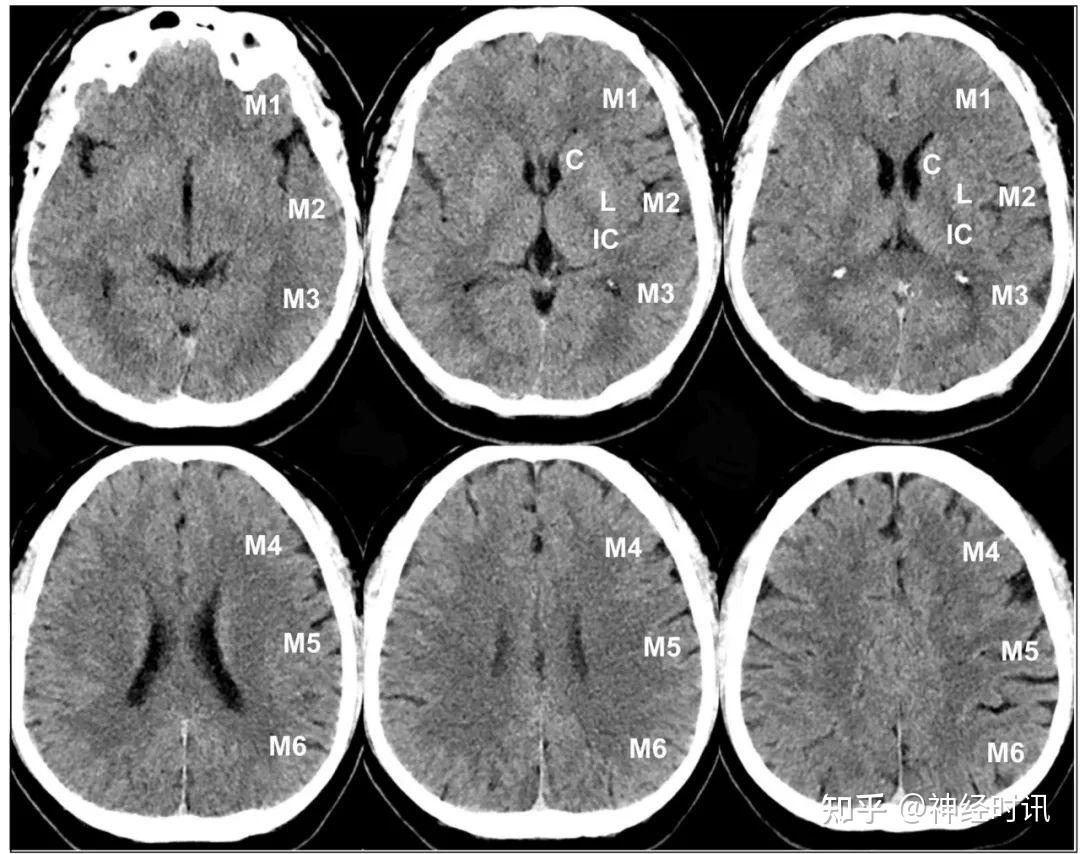 指导规范 | 急性缺血性脑卒中的影像学评估 - 知乎