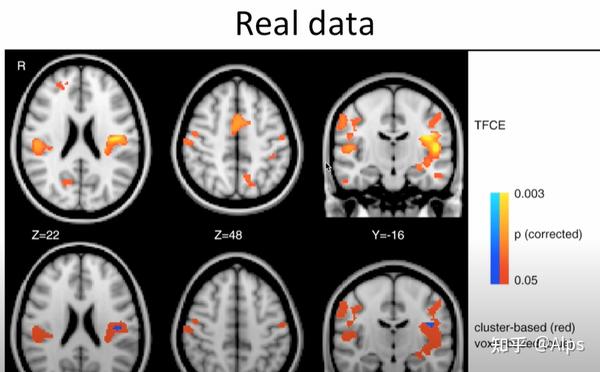 学习笔记1|什么是TFCE? (threshold-free cluster enhancement) - 知乎