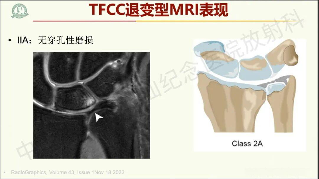 TFCC损伤MRI诊断 - 知乎