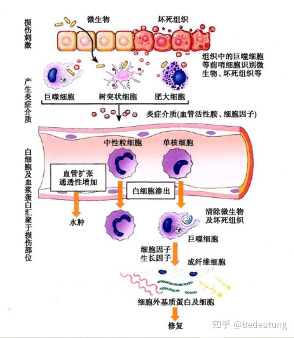 炎症的概念、原因和基本病理变化 知乎