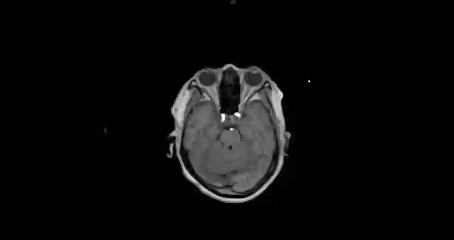 DCE-MRI (Dynamic Contrast-Enhanced Magnetic Resonance Imaging ) 动态对比增强磁 ...