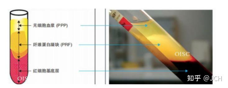 临床上所用的PRP、PRF和CGF都是血液制品，它们的区别在哪里？ - 知乎