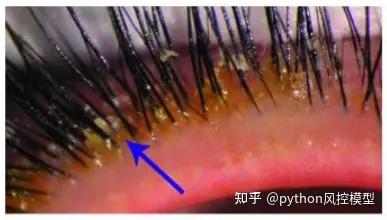 蠕形螨Demodex与皮肤病（睑缘炎/MGD/结膜炎/角膜炎/酒渣鼻/红斑痤疮/寻常性痤疮），万字详述（收藏） - 知乎