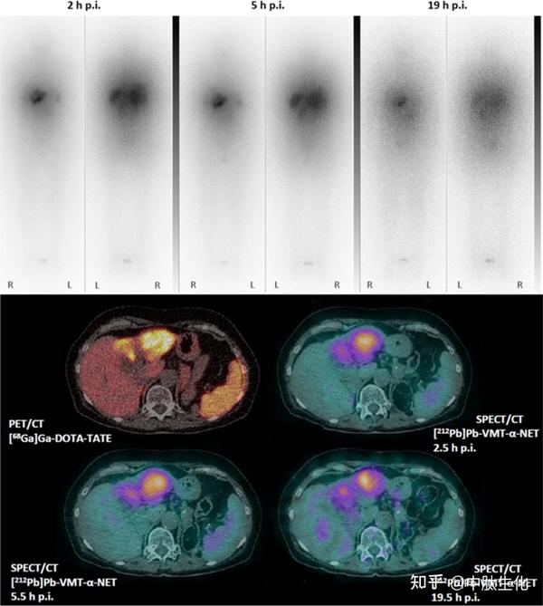 Tides 速递 | Perspective Therapeutics公布首例使用α发射同位素212Pb的人体SPECT图像 - 知乎