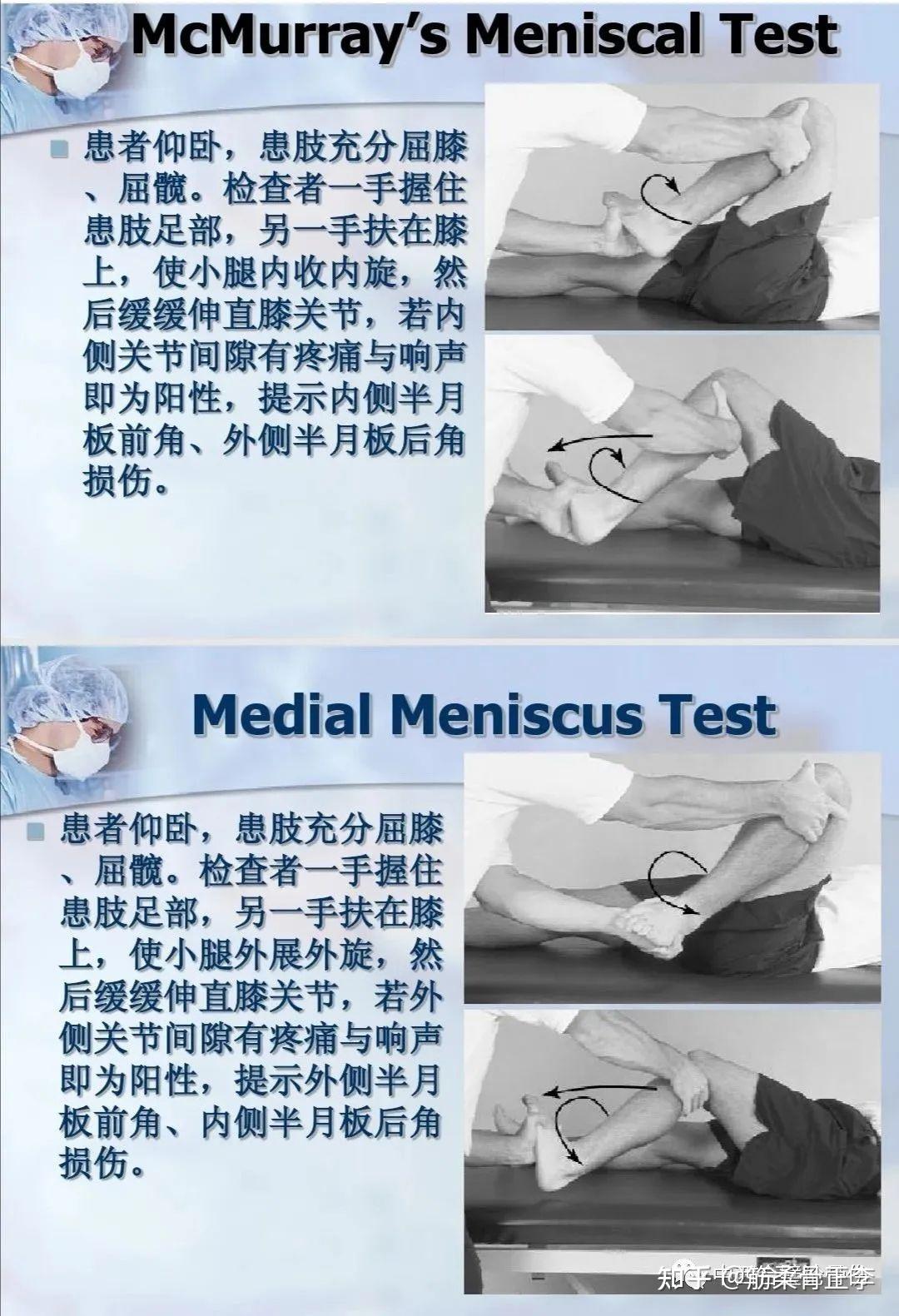关于膝关节麦氏征（Mc Murray's Test）的理解 - 知乎