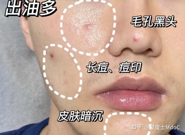 男生熬夜皮肤急救指南 拒绝暗黄跨脸 知乎