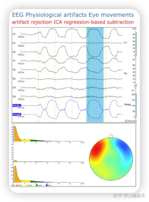 常见EEG伪迹波形图（基于analyzer分析软件展示） - 知乎