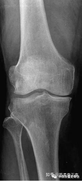 膝关节骨性关节炎的Kellgren-Lawrence (K-L)分级 - 知乎