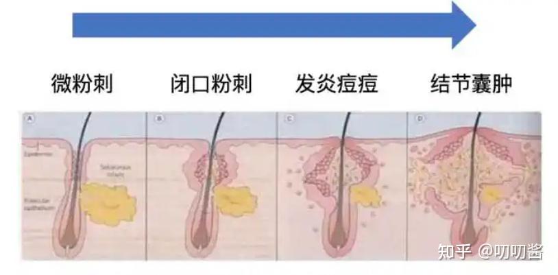 如何一周告别黑头与粉刺,轻松拥有蛋壳肌肤?快来听皮肤科医生怎么说! 知乎