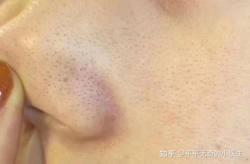 为什么皮肤科医生强烈建议你黑头爬满鼻子的时候,直接用泥膜去除? 知乎