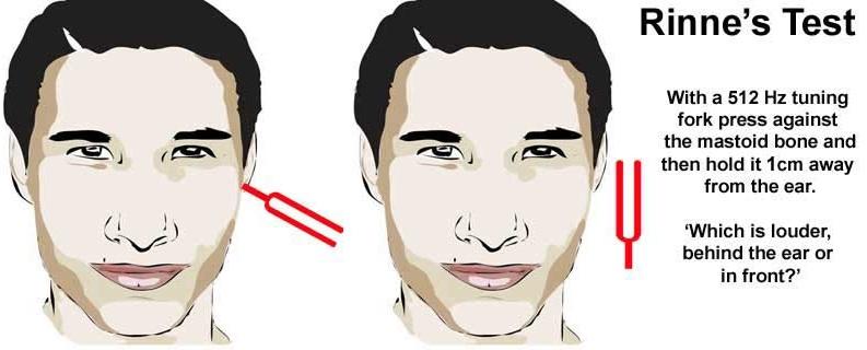 Rinne test vs Weber test - 知乎