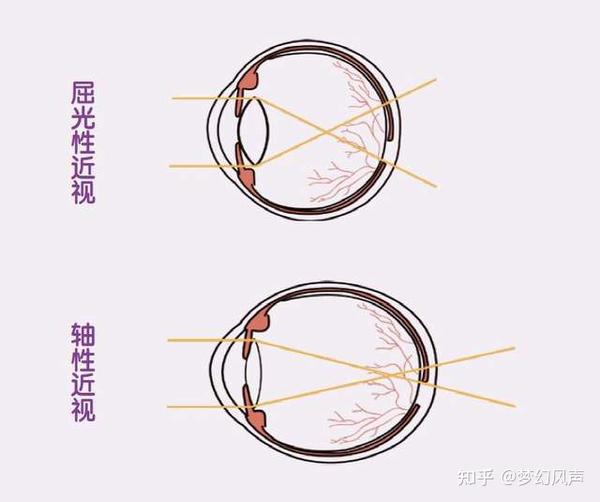 关于近视，还有哪些你不知道的事儿？ 知乎 3707