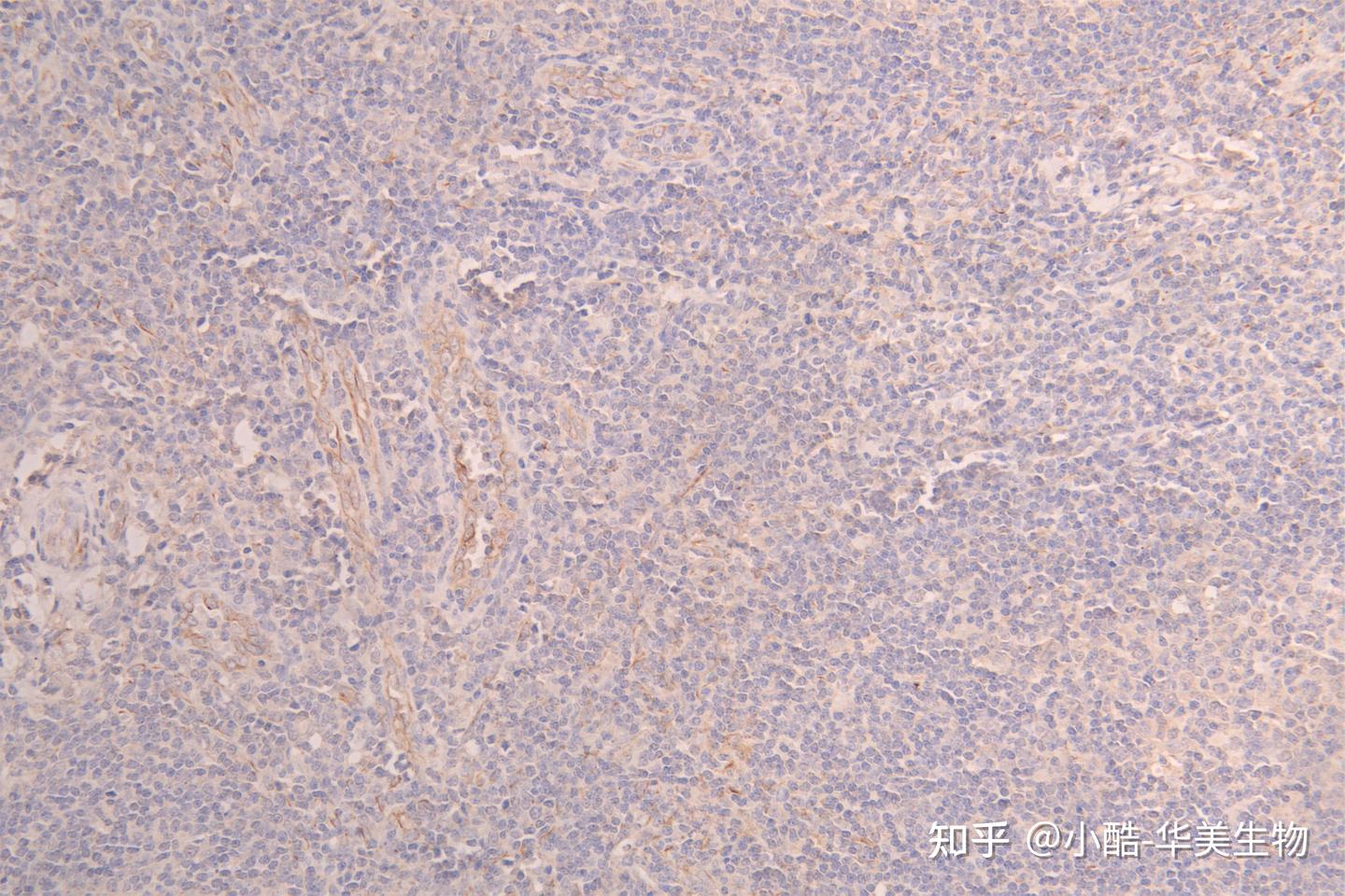 LAG3：肿瘤免疫治疗的下一个风口 - 知乎