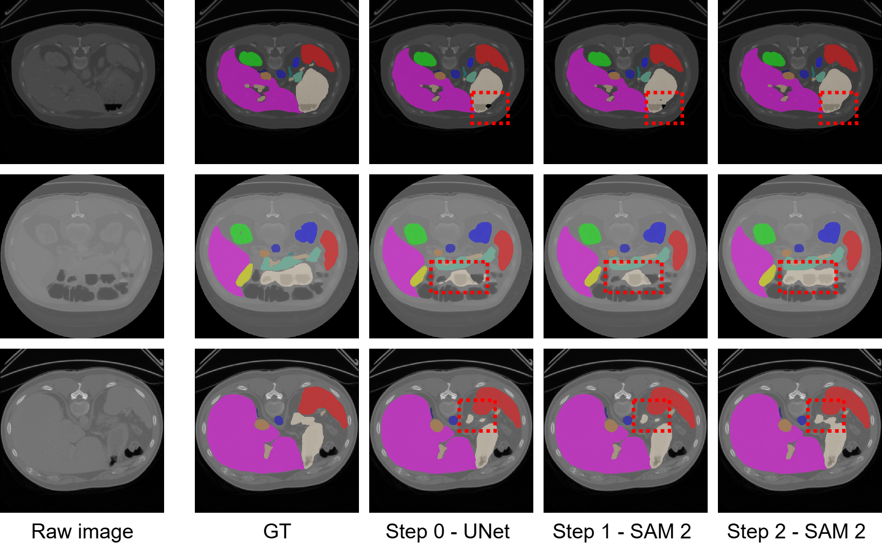 【arXiv 2502】RFMedSAM 2：基于SAM 2的自动提示精炼方法以增强体积医学图像分割性能（） - 知乎