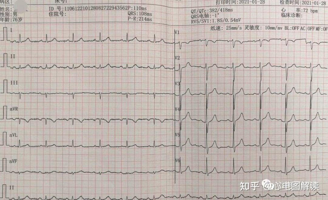 LAD 近中段发出D1处狭窄约95%--Wellens综合征 - 知乎