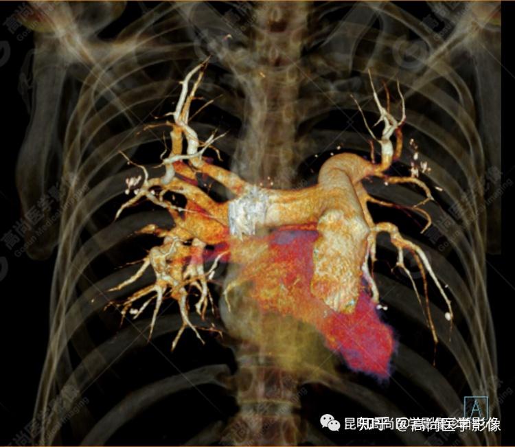 什么是CTA检查？哪些人需要做这个检查？ - 知乎