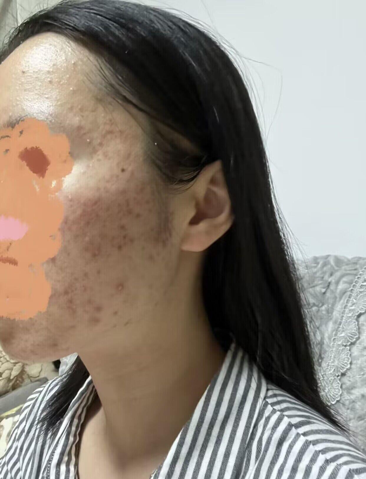 满脸痘印真的没了,能帮一个是一个! 知乎