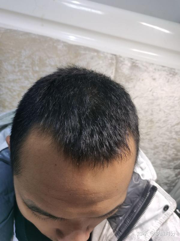 非那雄胺与米诺地尔一起用 - 知乎