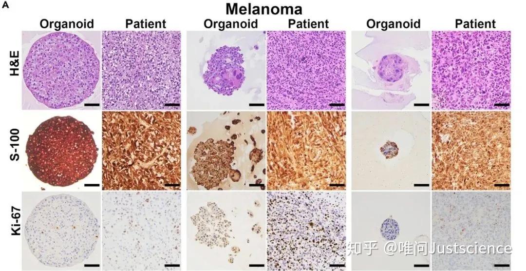 iScience：基于细针穿刺的患者来源癌症类器官 - 知乎