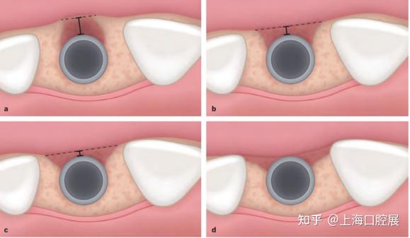 读书笔记|《30Years of Guided Bone Regeneration》 - 知乎
