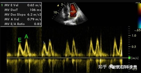 什么叫E/A ratio E/A比值 - 知乎