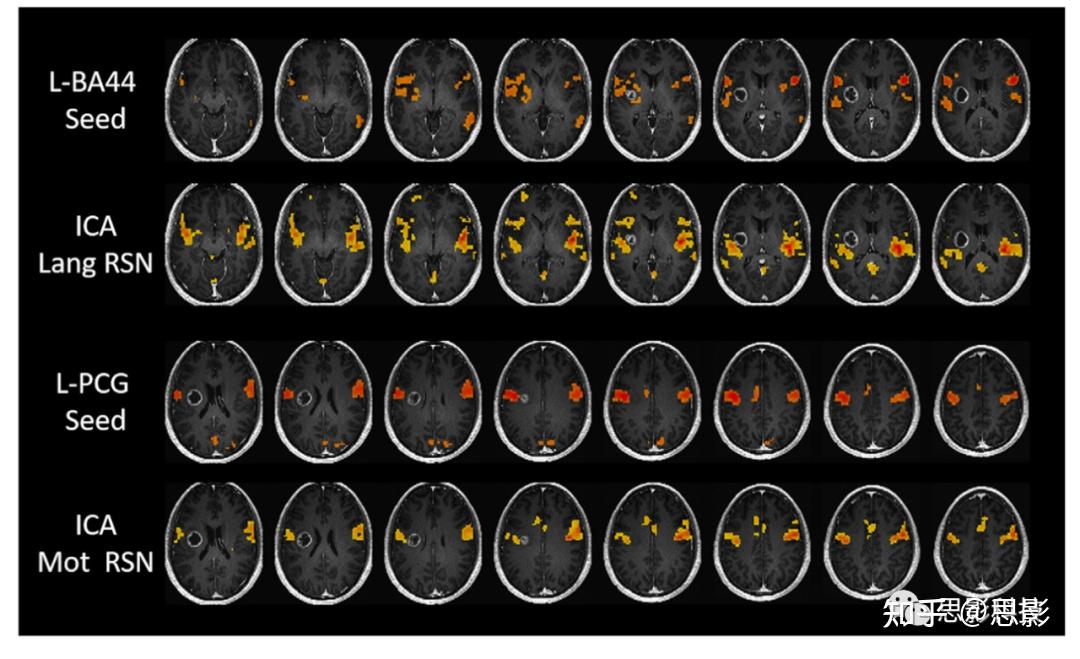 静息态fMRI的当前方法和新方向 - 知乎