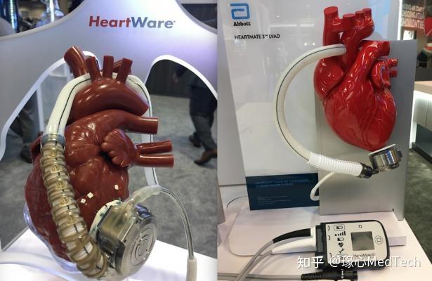 心室辅助装置 (VAD) - 知乎