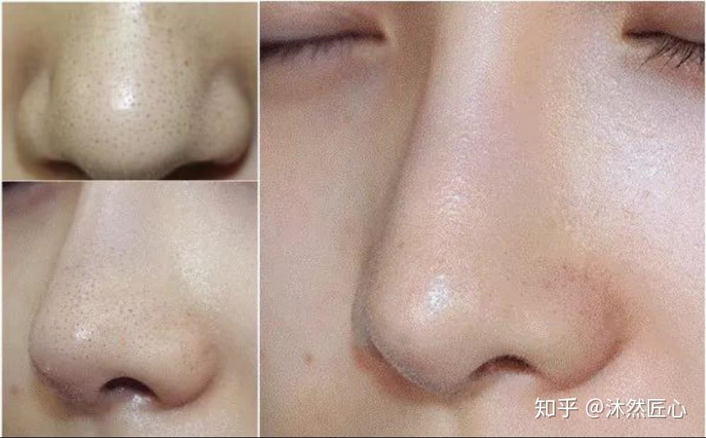 如何有效的去除黑头? 知乎