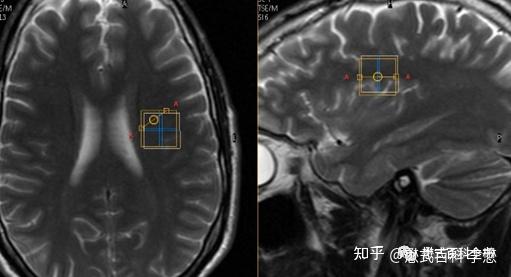什么是化学位移成像CSI？ - 知乎