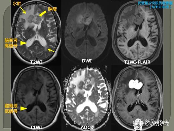 如何简单理解、认识MRI图像 - 知乎