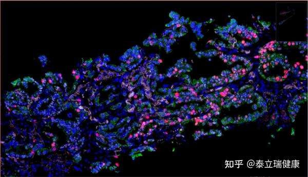 ChatGPT Q&A多重免疫荧光染色技术（mIF）在肺癌诊断、鉴别诊断及治疗上的应用 - 知乎