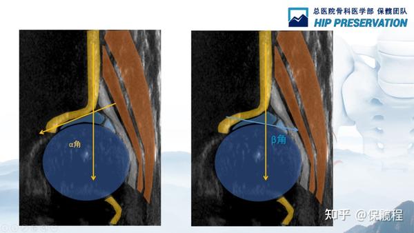 髋关节Graf超声筛查α角、β角到底是个啥？-保髋中国行昌都站2 - 知乎
