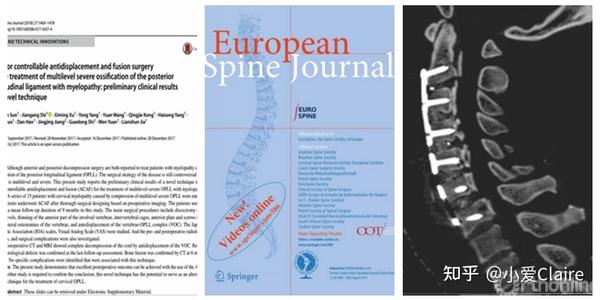 名医专访|上海长征医院脊柱外科缪锦浩：颈前路椎体骨化韧带前移融合术ACAF - 知乎