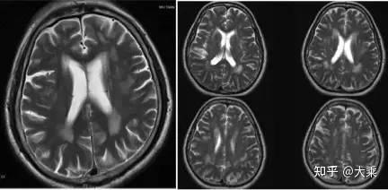 脑白质病变-Fazekas分级简介 - 知乎