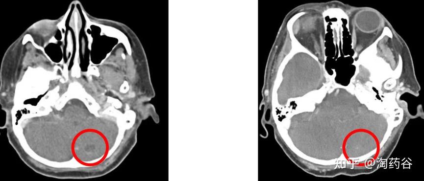 Ambrx 技术平台及ADC管线梳理 - 知乎